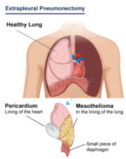 Extrapleural Pneumonectomy (EPP) | Pleural Mesothelioma Surgery